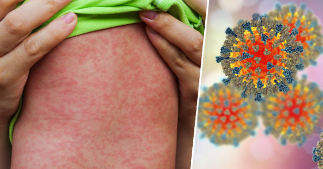 Mässling – symtom som avslöjar viruset | MåBra